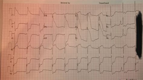 St Elevation In An Aortic Dissection Rems