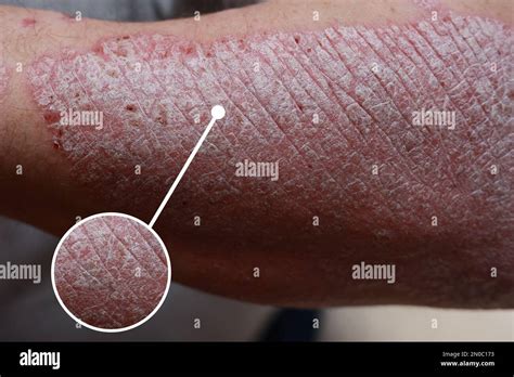 Macro Detailed Circles Magnification Of Psoriasis Skin Autoimmune