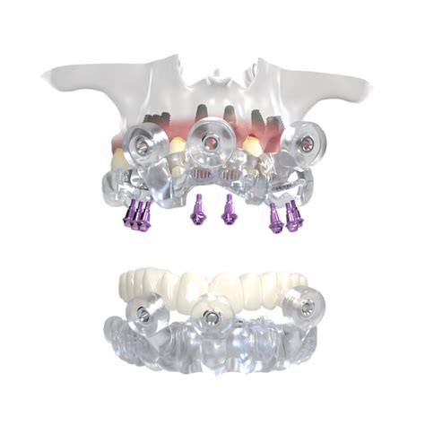 Straumann® Starconcept™