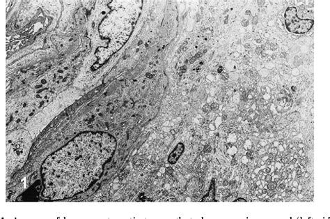 Figure 1 From Electron Microscopy Morphology Of The Mitochondrial Network In Human Cancer