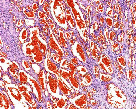 复合性血管内皮细瘤