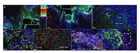 Representative Immunofluorescent Multiplex Findings In Melanoma Lmd