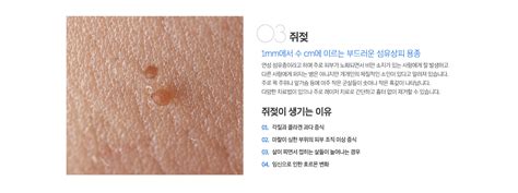 퍼스널 단점제거핀홀 피코 문신 제거 서울나인앤의원