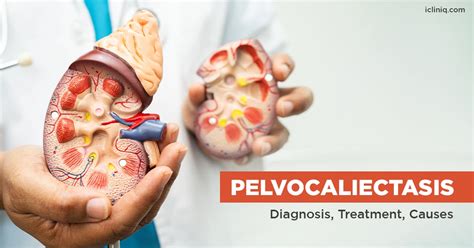 What Is Pelvocaliectasis
