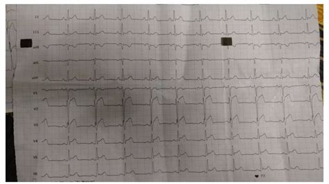 Acute Pericarditispptx