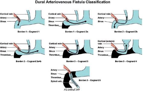 Cranial Dural Avf