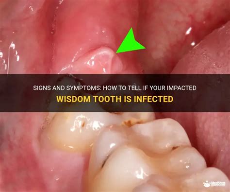 Signs And Symptoms How To Tell If Your Impacted Wisdom Tooth Is