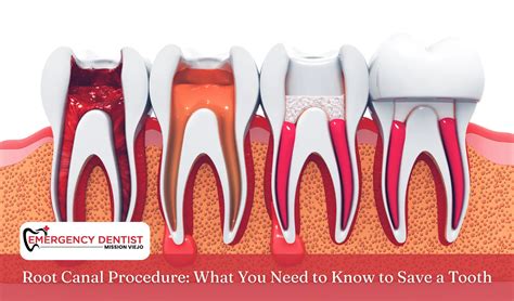 Root Canal Procedure What You Need To Know To Save A Tooth