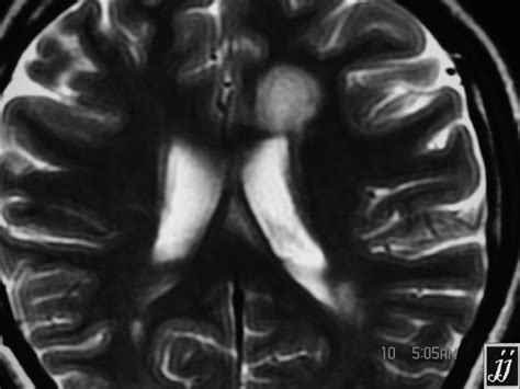 Tumefactive Ms With Enhancement Radiopaedia
