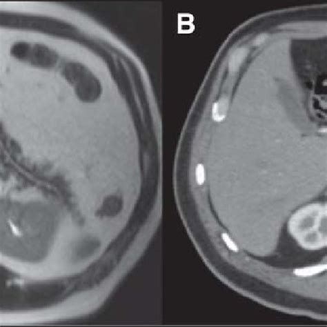 Laparoscopic Unblock Adrenalectomy With Partial Ivc Resection By Using