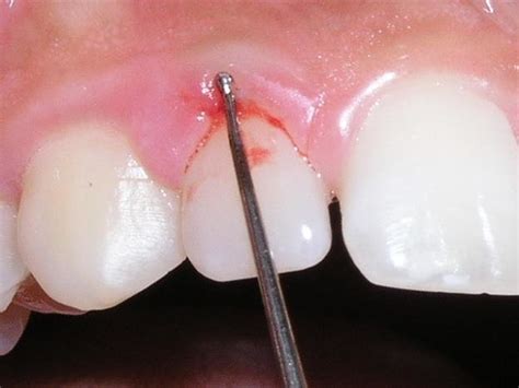 Cas Clinique Illustrant Le Code 1 Cpitn Download Scientific Diagram