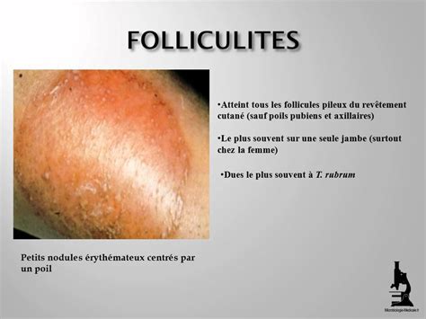 Dermatophyties Youtube