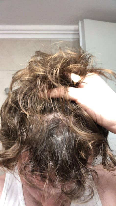 Finasteride 4 Months 22n Does It Cause Diffuse Thinning During