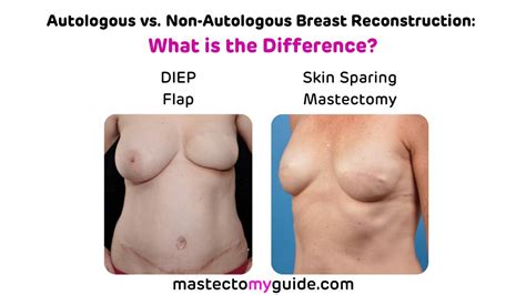 Breast Reconstruction Surgery Autologous Vs Non Autologous