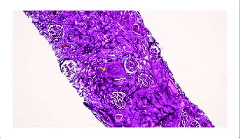 Renal Cortex Containing Glomeruli With Ischemic Type Wrinkling Of