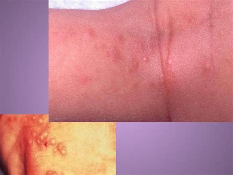 Common Pediatric Rashes Discussion Outline Dermatology Terminology Common