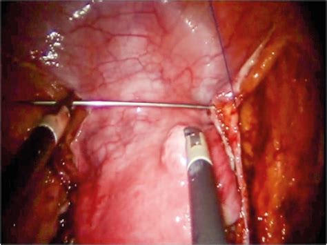 Robotic Single Site Radical Hysterectomy Plus Pelvic Lymphadenectomy In