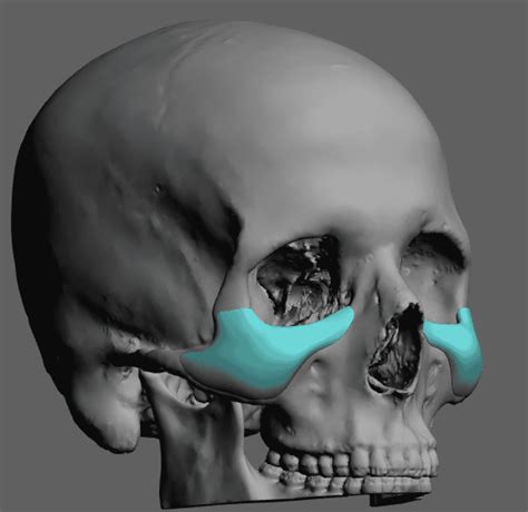 How Can My Negative Orbital Vector And Sagging Lower Eyelids Be Fixed