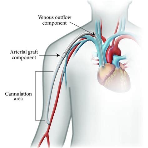 Steal Syndrome In A Brachiocephalic Fistula With Distal Hypoperfusion