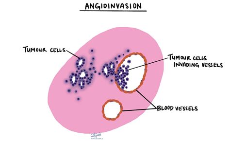 Angio Invasie Mypathologyreport