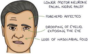 Facial Palsy Upper And Lower Motor Neuron Lesions Dr Mdm