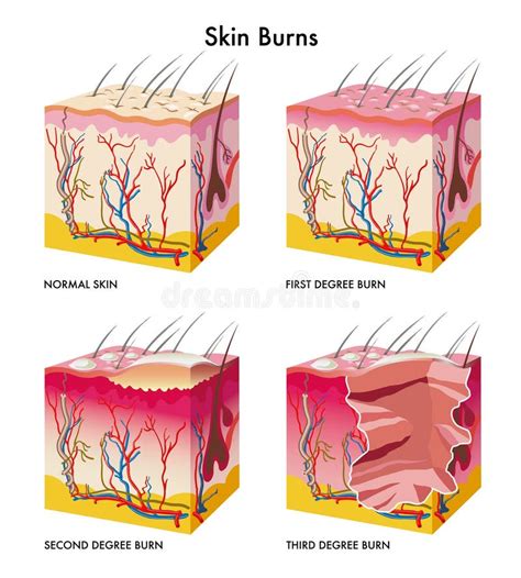 Skin Burn Classification Stock Vector Illustration Of Medical 50132291