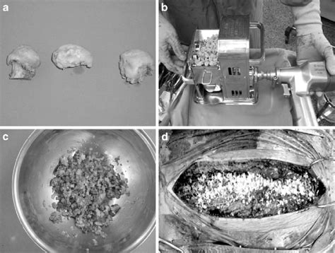 A Banked Allograft Bone Obtained From Kitasato University Bone Bank B