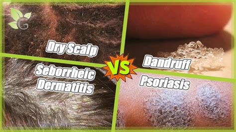 Dry Scalp Psoriasis