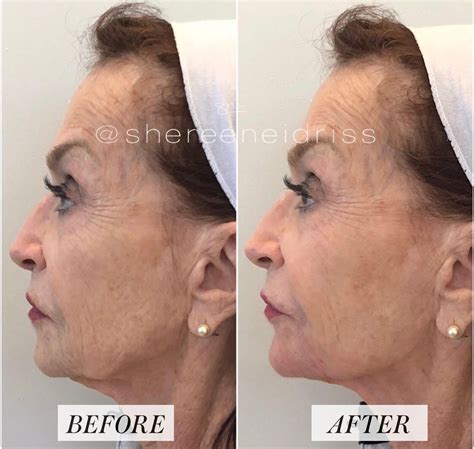 Our Guide To Facial Fillers From Treatment Options To Recovery Time
