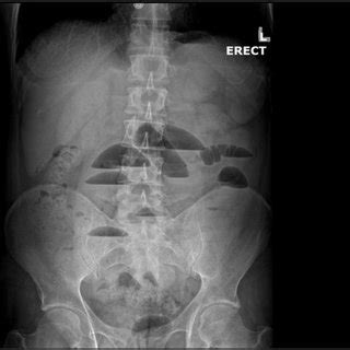 Abdominal X Ray Radiography Showing Air Fluid Levels Representative Of