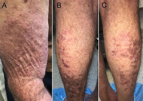 Nephrogenic Systemic Fibrosis Mortality