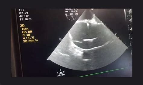 Islam Mohammad Shehata On Linkedin Dissection Tee Cardiacarrest