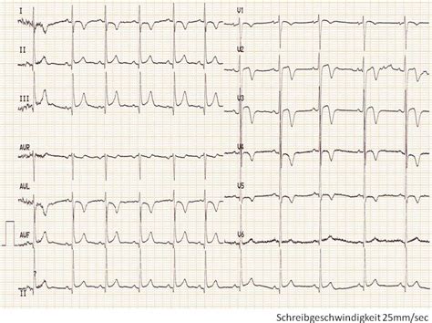 Lead Systems How An Ecg Works Cardiosecur
