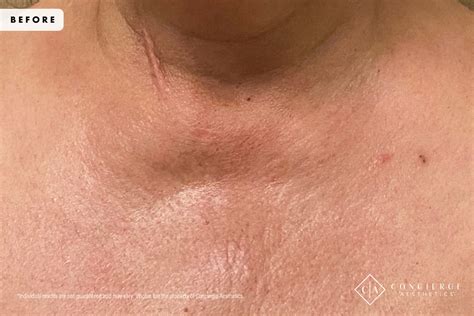 B And A Morpheus8 64 Yo Concierge Aesthetics