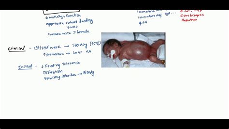 Necrotizing Enterocolitis Stage
