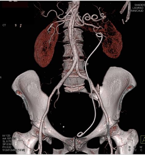 Double J Stent With Distal Stent Still In Distal Ureter Nicely Shown In