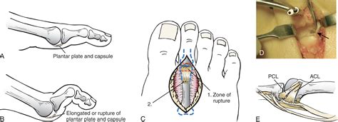 Lesser Toe Deformities Clinical Tree