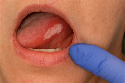 Leukoplakia Objawy Przyczyny Aktualne Leczenie Poradnik 2025