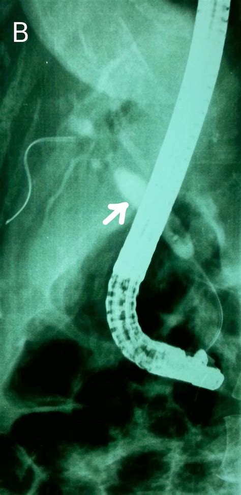 Ercp And Egd Fourth Follow Up Ercp For A Post Cholecystectomy Cbd Stricture