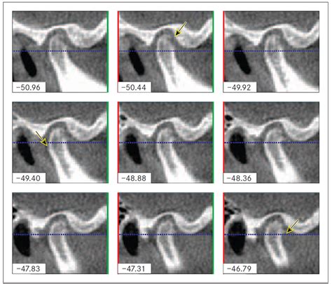 Mandibular Condyle Characteristics In Juvenile Idiopath Rsu