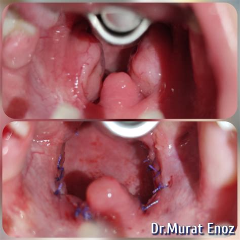 Tonsillectomy Operation In Istanbul