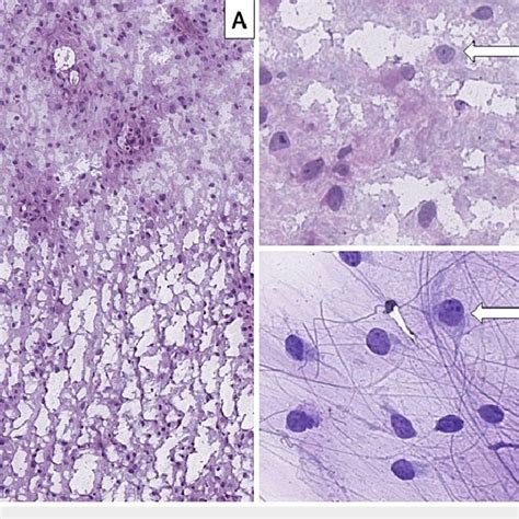 Frozen Section Neuropathology Of The Tumor A Cellularity Suggestive Of