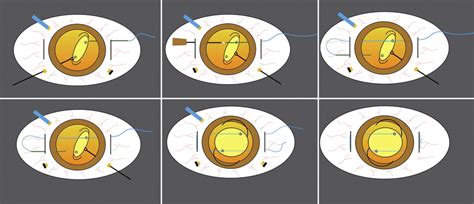 Schematic Representation Of The Surgical Technique A 9 0
