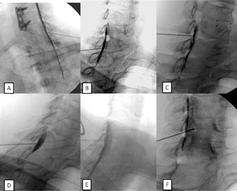Figure 4 From Cervical Epidural Contrast Spread Patterns In