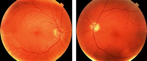 Fundus Photo Showing Inferotemporal Disc Pallor In The Left Eye