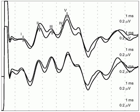 Brainstem Auditory Evoked Potentials Neupsy Key