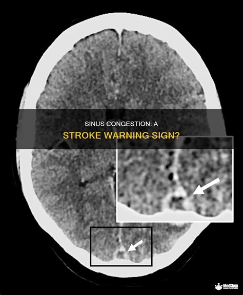 Sinus Congestion A Stroke Warning Sign Medshun