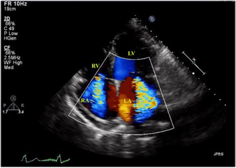 2d Colour Doppler Echocardiography Judahcare Cardiology And Diagnostics