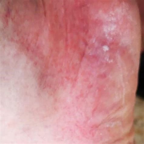 Pdf Immediate And Delayed Hypersensitivity Reactions To Corticosteroids Prevalence