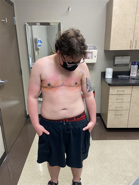 Double Mastectomy Post Op
